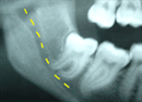 Wisdom Teeth | Fairfield Oral and Maxillofacial Surgery